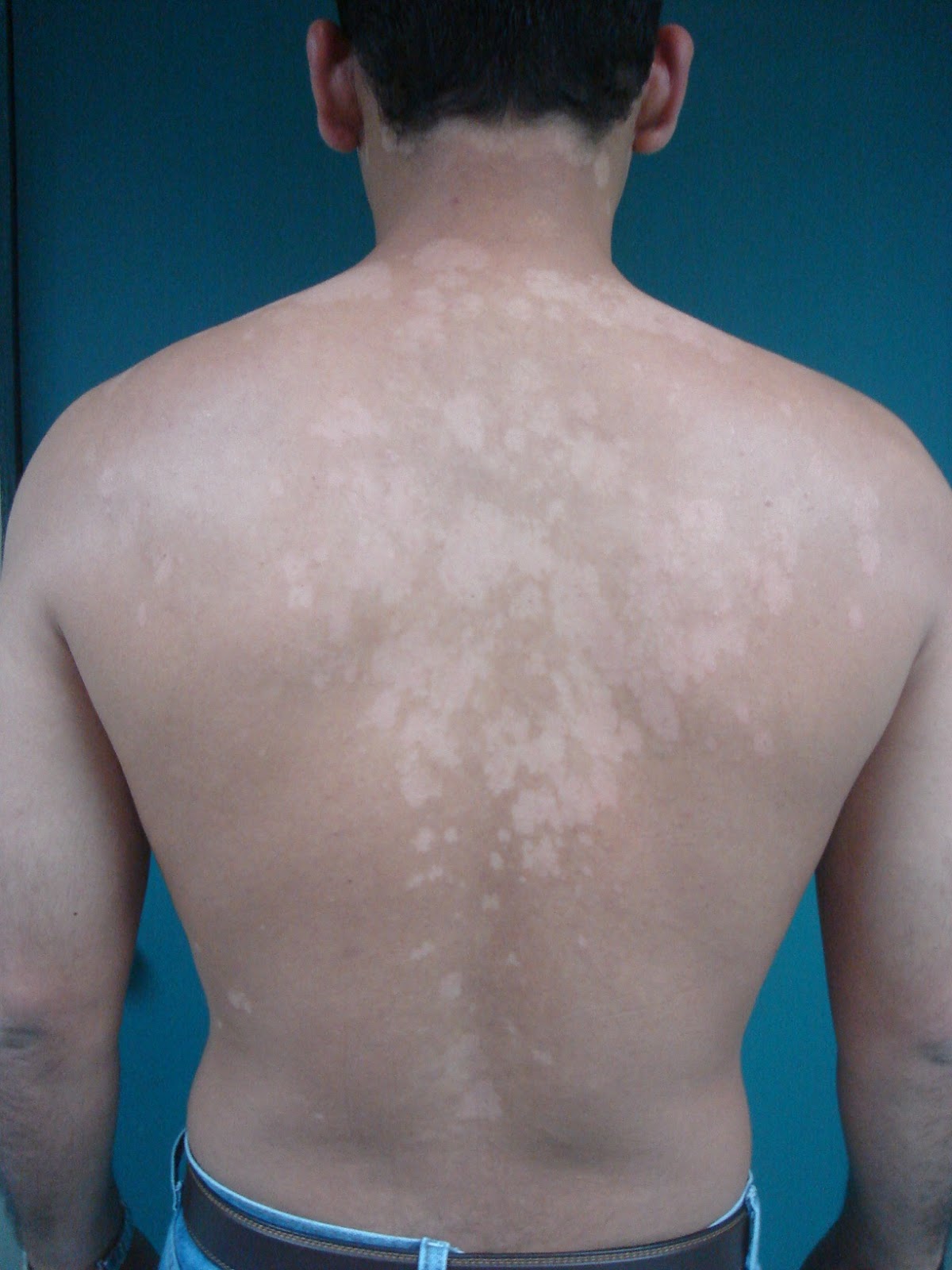 La Dermatosis de la Semana: Pitiriasis versicolor