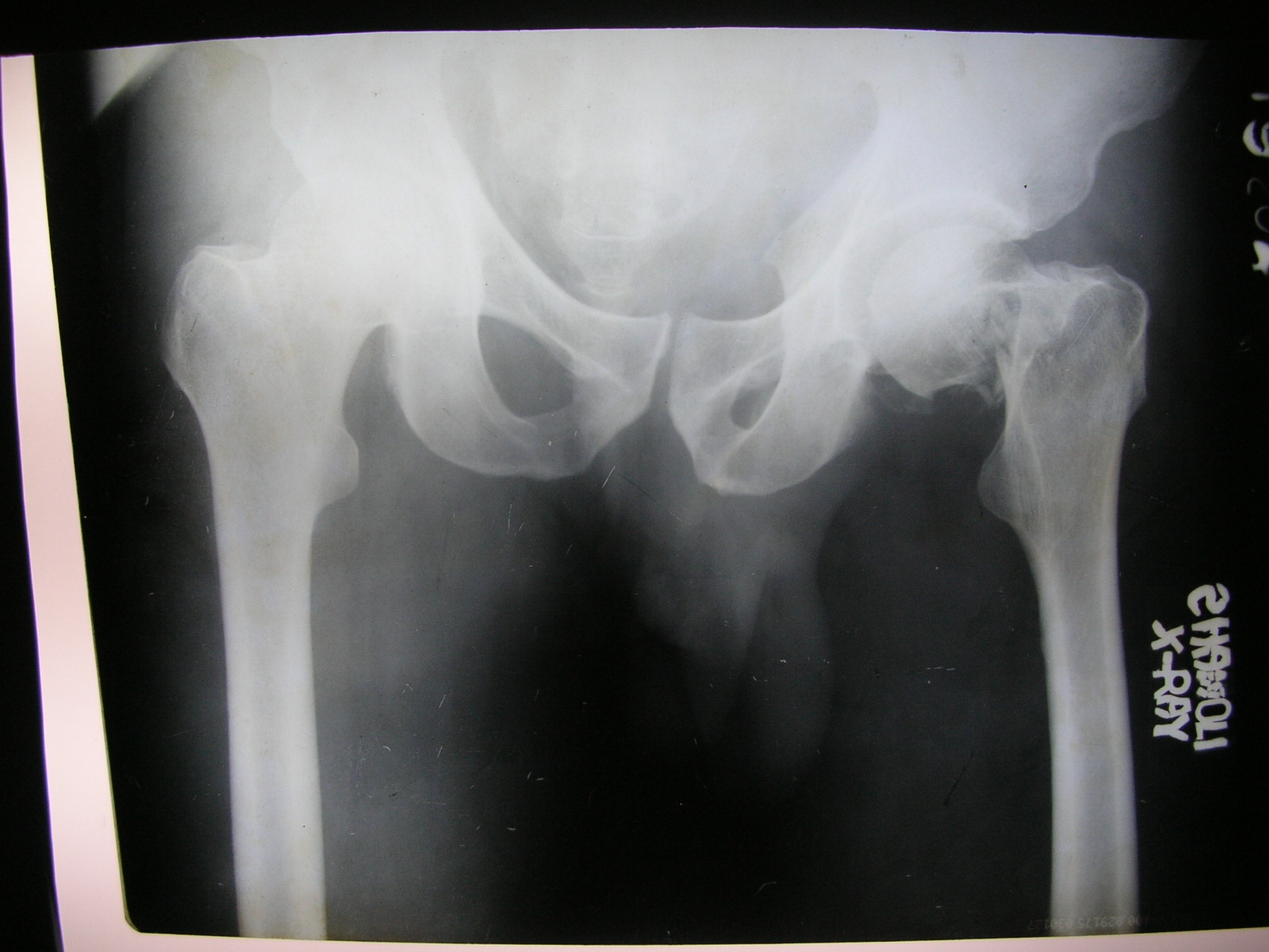 X-rays and Slides: Fracture neck of femur (Garden type IV)