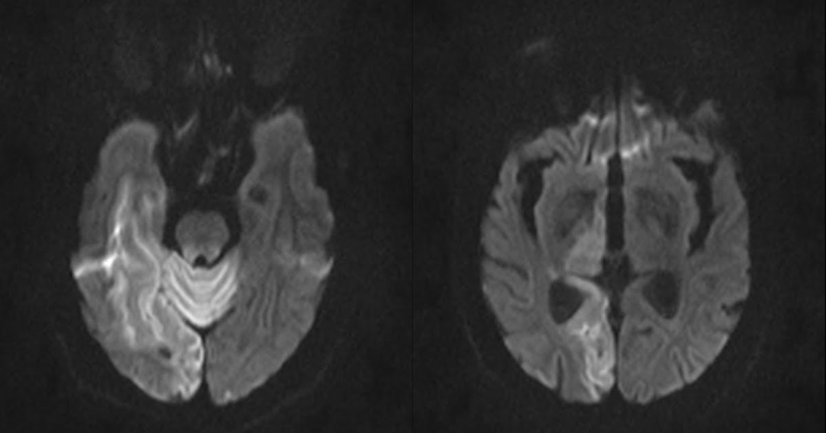 Ultimate Radiology : Which arterial occlusion to suspect?