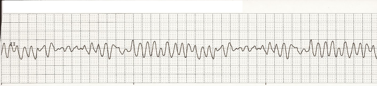 EKG Rhythm Strip Quiz 4