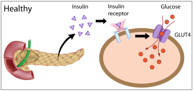 Great-West Life: Group Benefits: In everyday language, what is diabetes?
