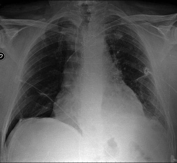 Tecnicos Radiologos: Signo del surco profundo en Neumotórax