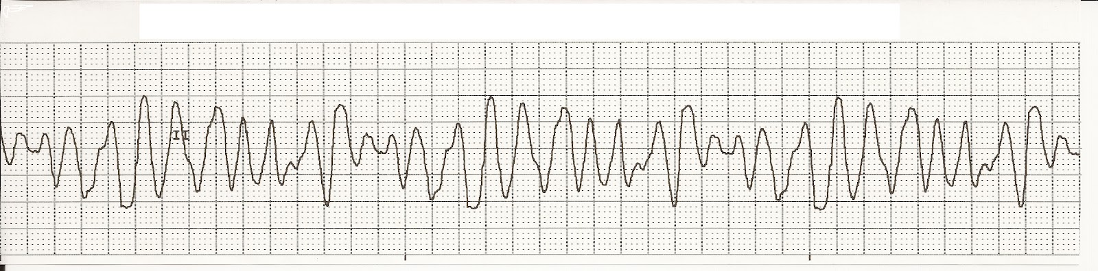Coarse Ventricular Fibrillation Rhythm Strip