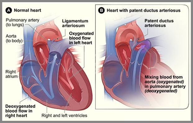 Persistent ductus arteriosus