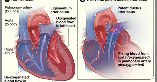 Persistent ductus arteriosus