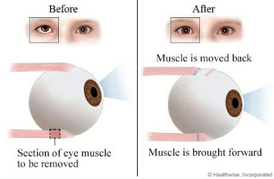 Best Eye and Vision Centre at India: Squint Treatment in Mumbai