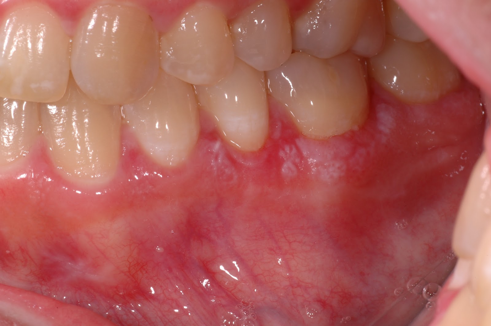 Oral Lichen Planus