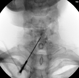 Wanderplace: The Six Thousand Dollar Man: The Epidural