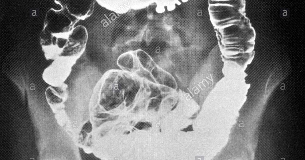 Common Diagnostic of Barium X-ray Studies