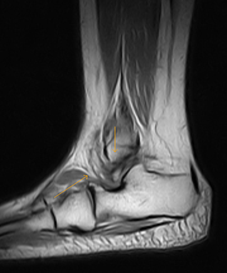 Anterolateral Ankle Impingement-MRI - Sumer's Radiology Blog