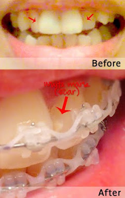 White Mark (Scar?) | 966 Days of Braces