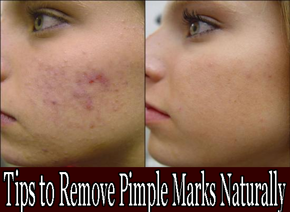 How To Remove Pimple Marks - Health Villas