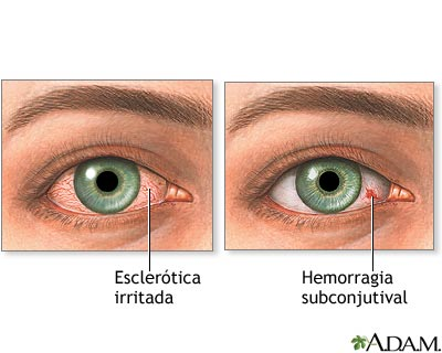 Un Médico Online: HEMORRAGIA SUBCONJUNTIVAL - OJO ROJO ROJO NO DOLOROSO ...