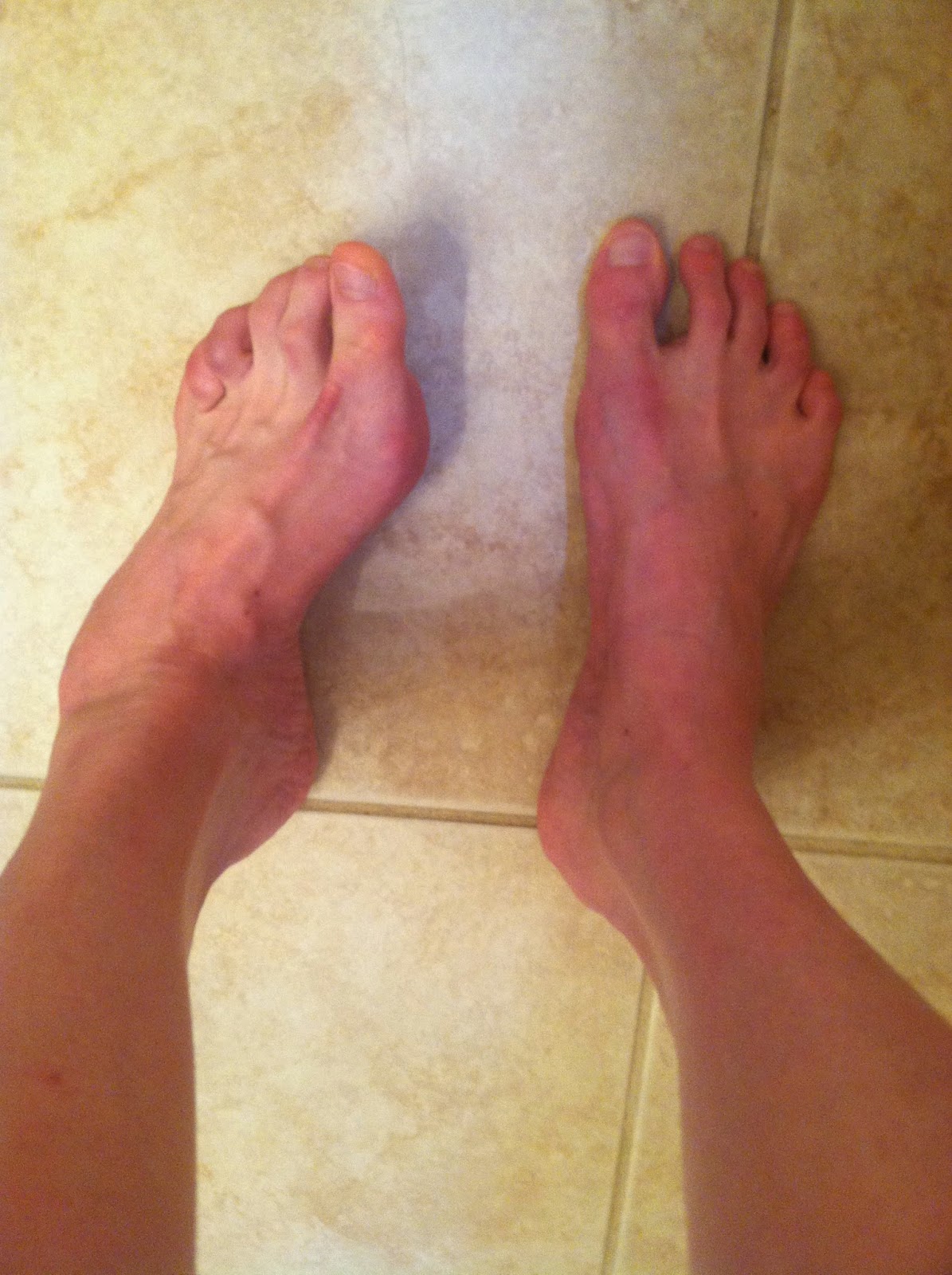 It is Not Brain Surgery!: Day 27 - Dystonia and Beautiful Feet