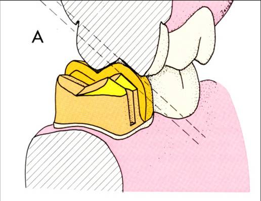 FUNCTIONAL CUSP BEVEL ~ Welcome To Dental lecture Class