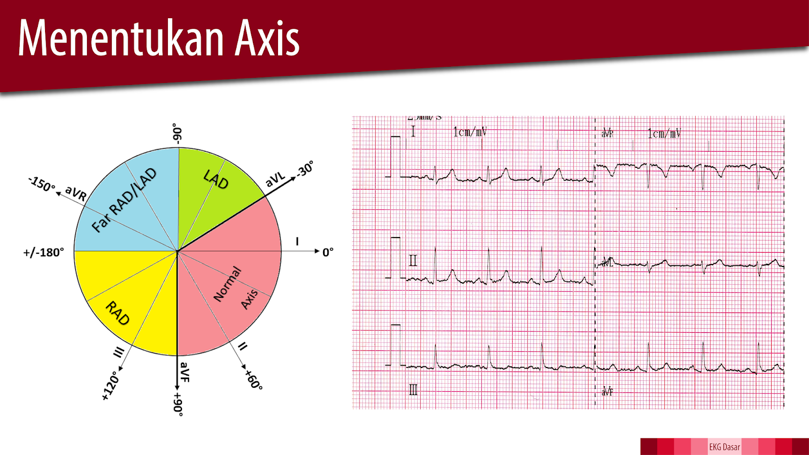 EKG Dasar; Workshop EKG | Dokter Alfa : Belajar Kedokteran