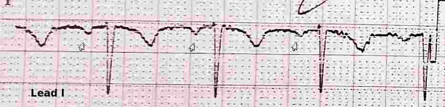 ECG Challenge 4 - the Axis