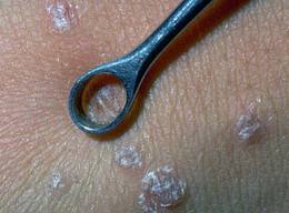 Kesihatan, Kecantikan Dan Petua: MENANGGALKAN KUTIL