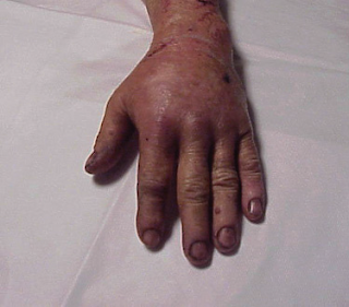 Download Medical books for free: Intense Pain Following High-pressure ...