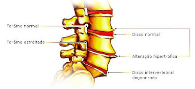 Vie Clínica de Fisioterapia: LOMBALGIA