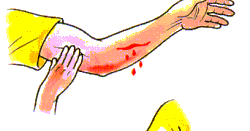 Esternocleidomastoideu: Hemorragias - o que fazer