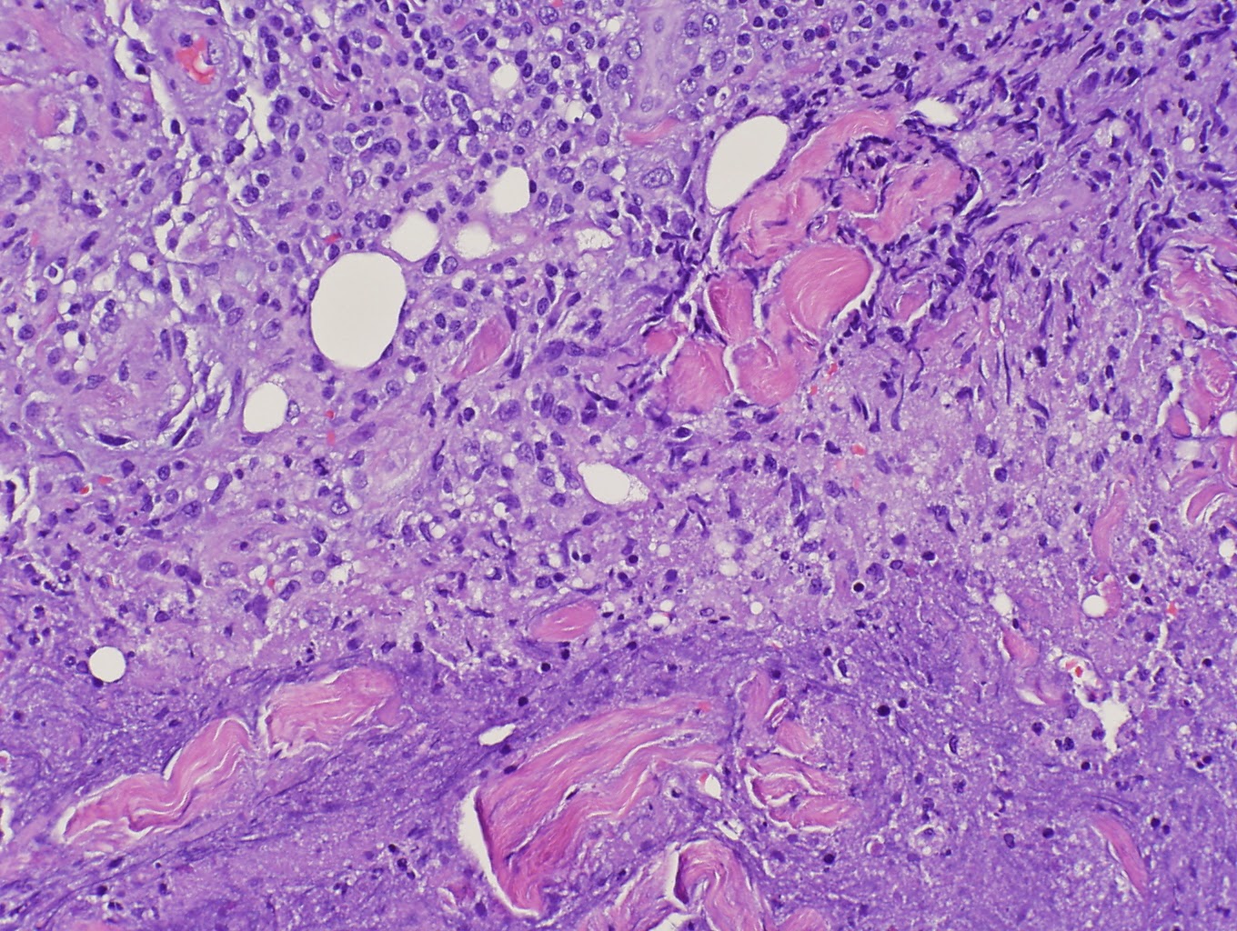 VIRTUAL GRAND ROUNDS IN DERMATOLOGY 2.0: Cervical Nodules in a Healthy ...
