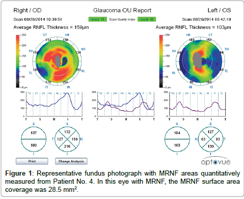 Journal and Conferences on Ophthalmology: Myelinated Retinal Nerve ...