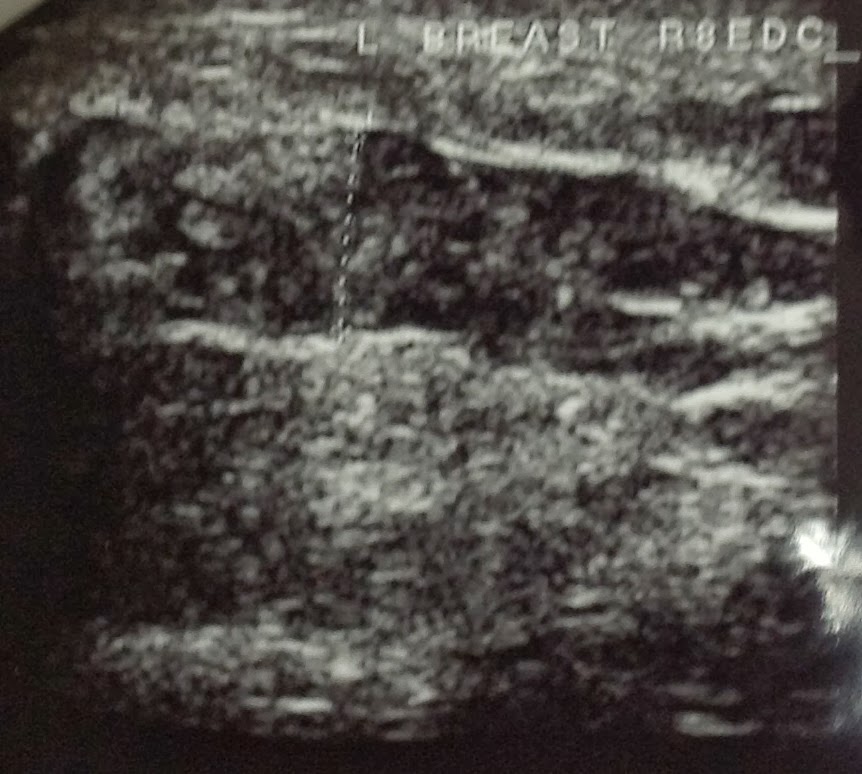 AUTOVACUNAS: Mastitis Infecciosa