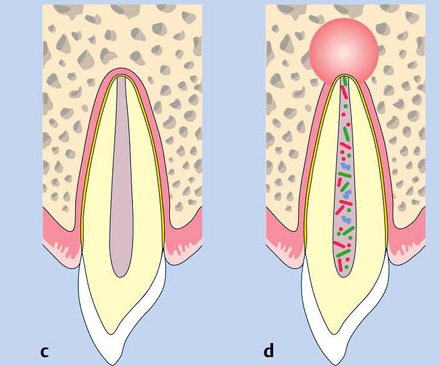 PERIODONTITIS APICAL: Una de las consecuencias del tabaquismo