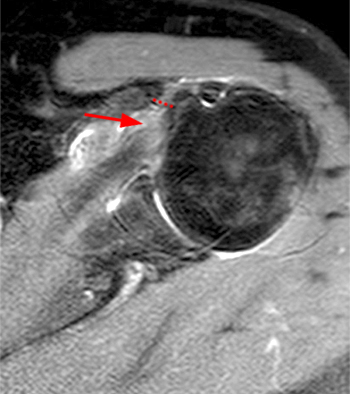 MRI Musculo-Skeletal Section: Coracoid bursa.