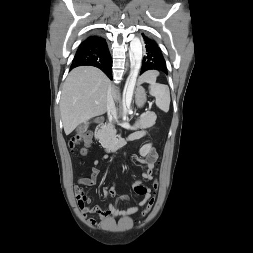 CXR 胸部x光判讀 aortic dissection