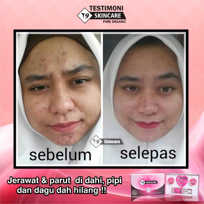 T9 SKINCARE: TIPS HILANGKAN JERAWAT BATU & RESDUNG