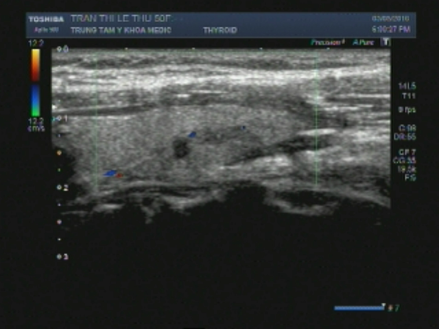VIETNAMESE MEDIC ULTRASOUND: CASE 493: THYROID SMALL PTC, Dr PHAN THANH ...