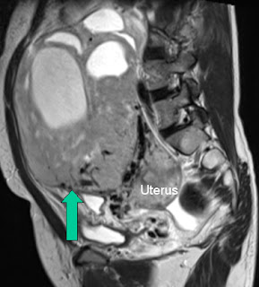 mricases: Large Degenerative Hemorrhagic Sessile Subserosal Uterine Fibroid