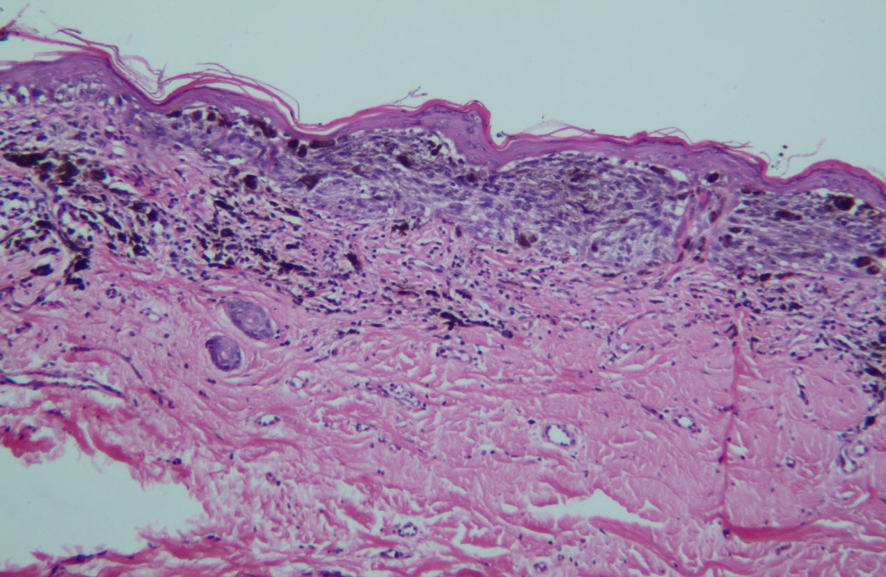 Consultations in Dermatoscopy: Dysplastic Junctional lentiginous nevus