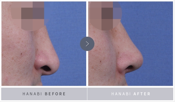 Best nose job clinic in Korea: Pointy nose rhinoplasty