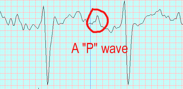 Beat Lone Afib: How To Monitor Your Heart