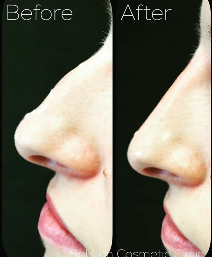 Selston Cosmetic Clinic: A Non-Surgical Nose Job For a Perfect Facial ...