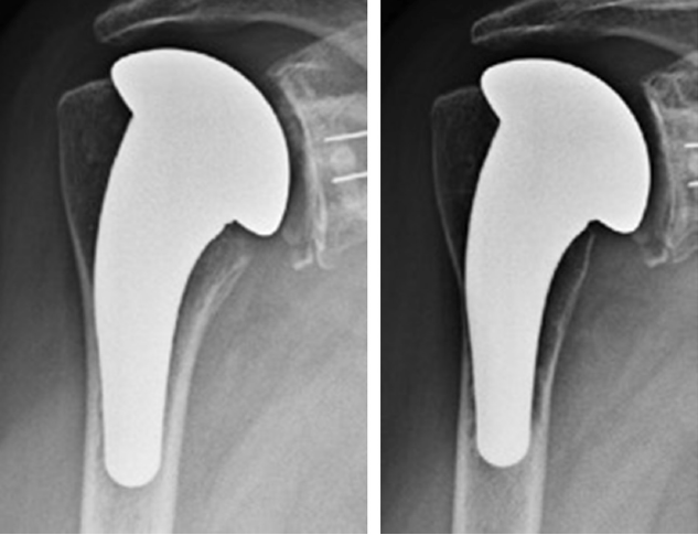UW Shoulder and Elbow Academy: Short stem humeral prosthesis: the risk ...