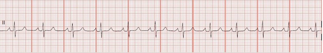 EKG Rhythm Strip Quiz 34