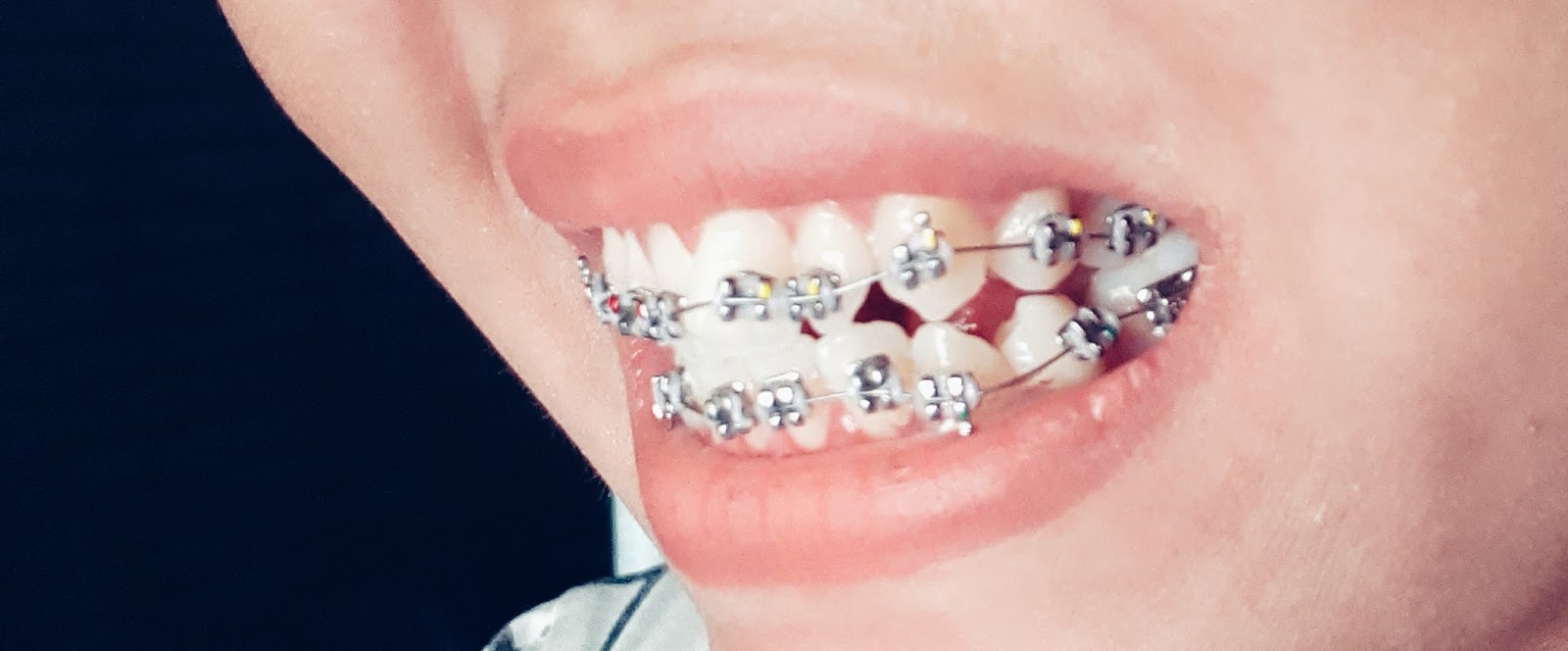 Pemasangan Behel dan Biayanya di FDC Dental Clinic Klender