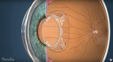 Biomedical Engineering: Bionic Lenses: Eagle Eyes