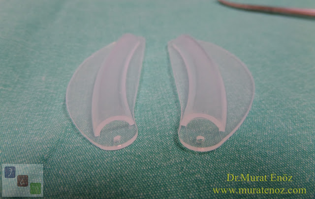 Rhinoplasty Recovery Guide 👃 - 34 - Internal Nasal Splints Removal ...