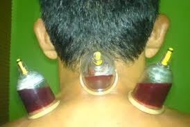 TERAPI BEKAM GRESIK | RUMAH BEKAM GRESIK | RUMAH HERBAL GRESIK | TEMPAT ...