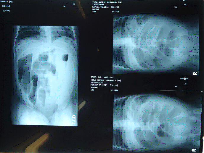 Kasus Intususepsi pada anak dengan milking procedure ~ Pediatric Surgery