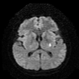 Dr Balaji Anvekar FRCR: Lacunar infarct MRI