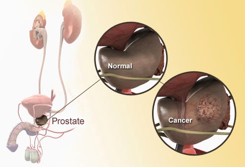 Healthy Life: Prostate Cancer