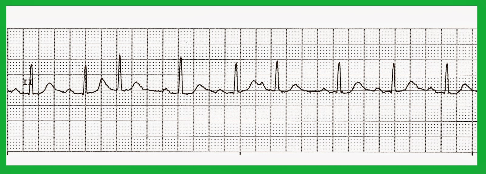 Practice EKG Strips 317