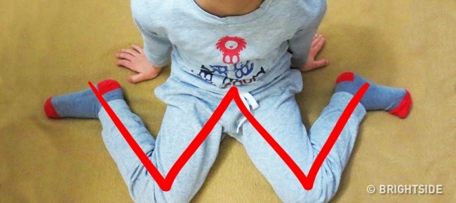 Jangan Biarkan Anak Anda Duduk Bersimpuh Katak Atau Berbentuk 'W' Begini