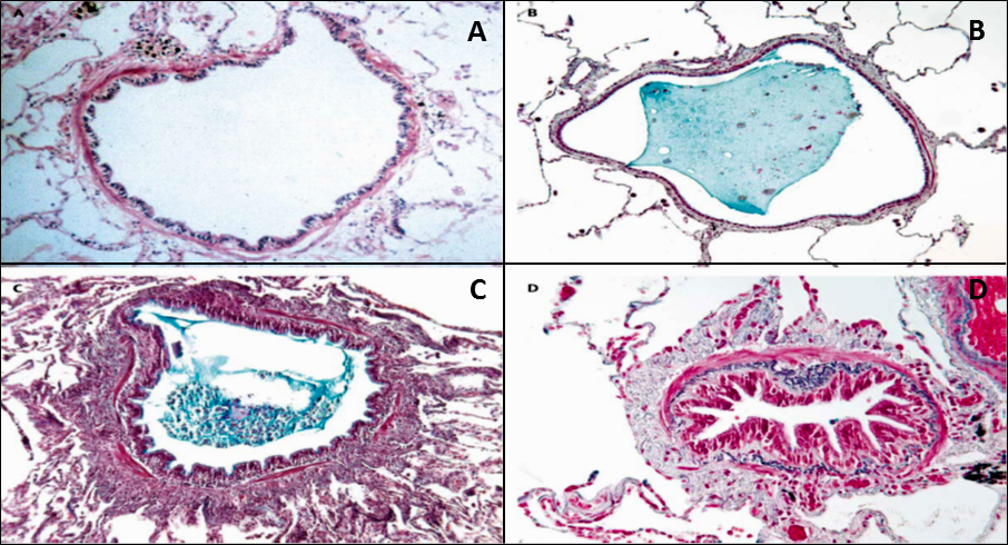 Chronic Obstructive Pulmonary Disease (COPD): Dr Younis Khan